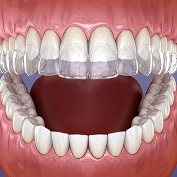 Invisalign Allen | Straighten Teeth Without Braces | Allen Smile Design